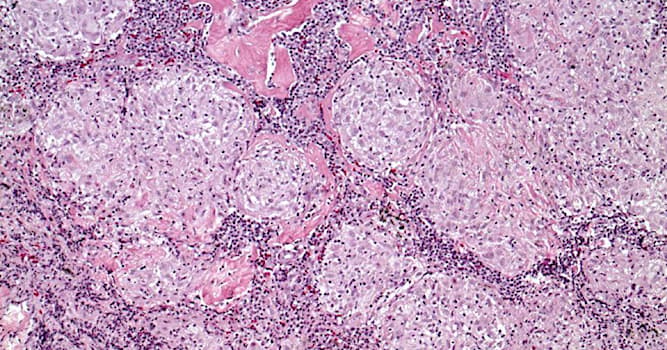 What is Besnier–Boeck–Schaumann disease? | Trivia Questions